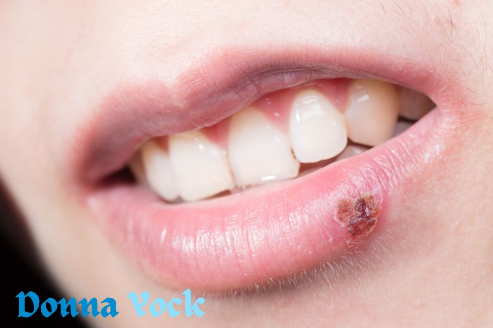 How to Naturally Remove Canker Sores - Donna Yock Dentist